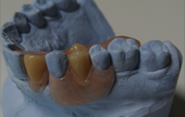 Prothèse Nylon Deflex Emcolab Dental