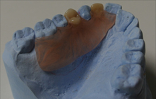 Prothèse Nylon Deflex Emcolab Dental