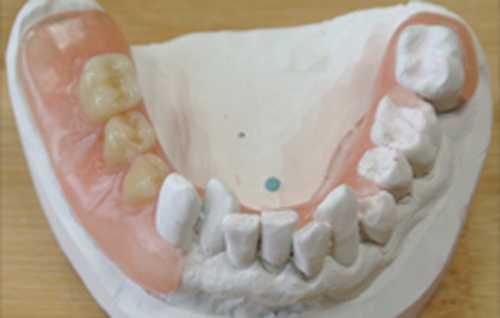 Prothèse Nylon Deflex Emcolab Dental